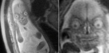 MRI Pictures Of Baby Evoke Horror