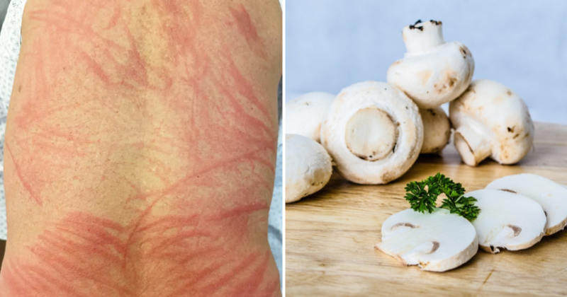 Rare 'Shiitake Rash' Develops In Man After Eating Undercooked Mushrooms