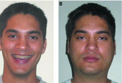 Mumps Cases Rising In Delhi-NCR! Everything To Know About This ...