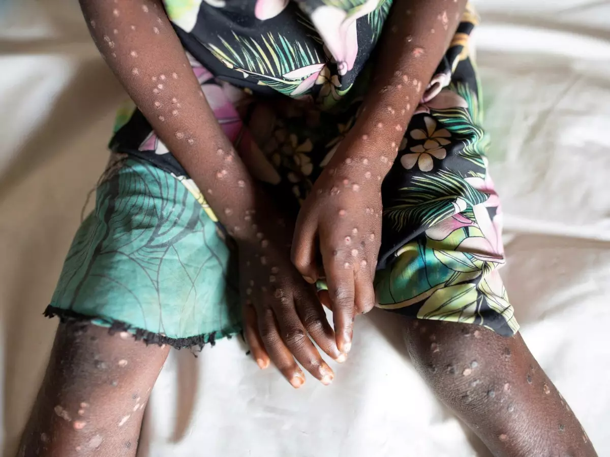 AIIMS issues guidelines for Monkeypox cases in Delhi amid growing ... AIIMS issues guidelines for Monkeypox cases in Delhi amid growing ...