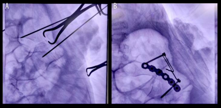 Extremely Rare Conjoined 'Spider Twins' Have Four Arms, Three Legs