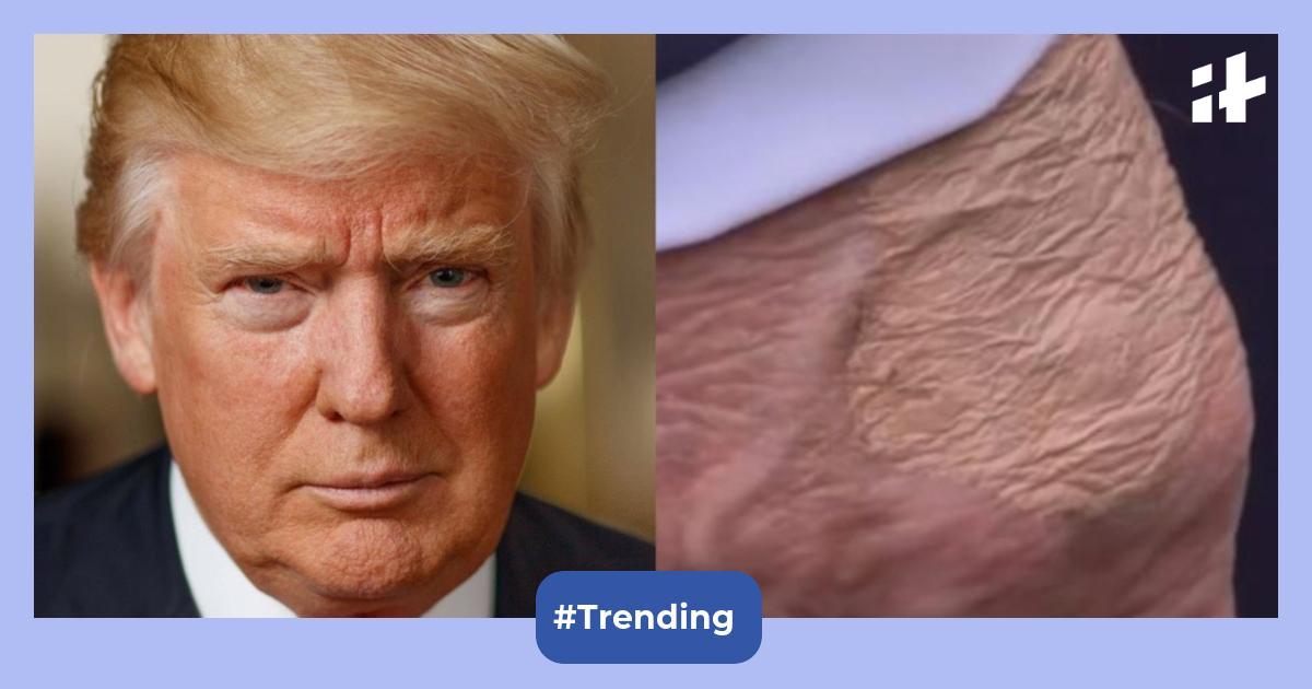 Makeup over mystery? Donald Trump's bruised hands ignite 'congestive ...