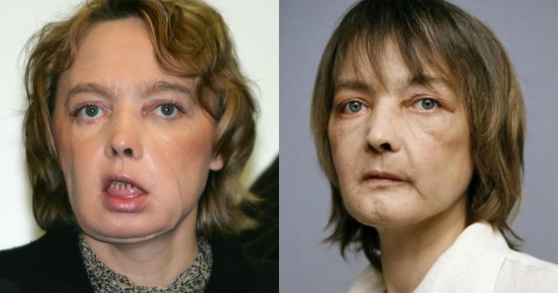 Woman Who Received The World's First Face Transplant Dies Of Cancer 11 ...