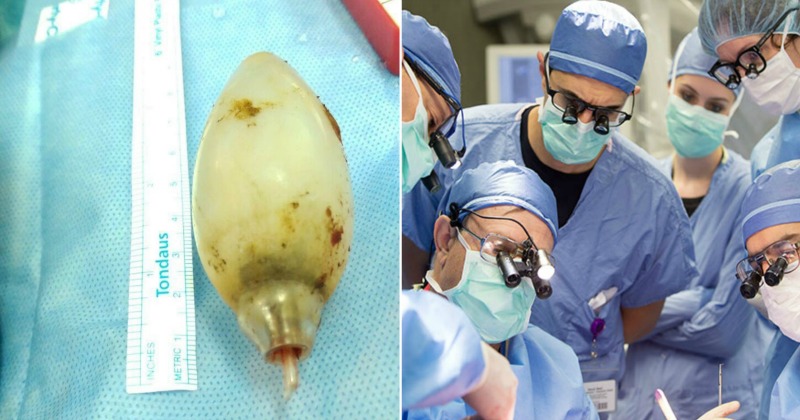 He Swallowed A Light Bulb As A Kid And Came To Regret It 11 Years Later