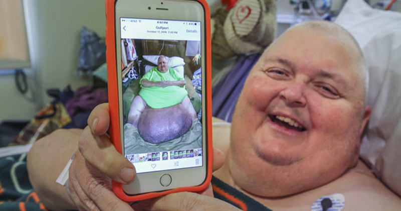 Initially Assumed Just Fat, This Mississippi Man Actually Had A 60 Kg ...