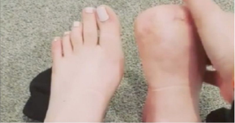 Beauty Treatment Gone Wrong - Woman Loses Toes After A Session Of Fish ...