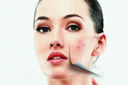 How to Prevent Winter Acne