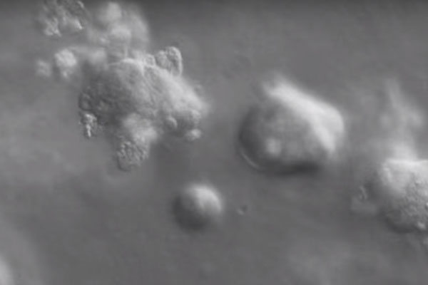 For The First Time, Scientists Have Seen Cancer Cells Growing Into ...