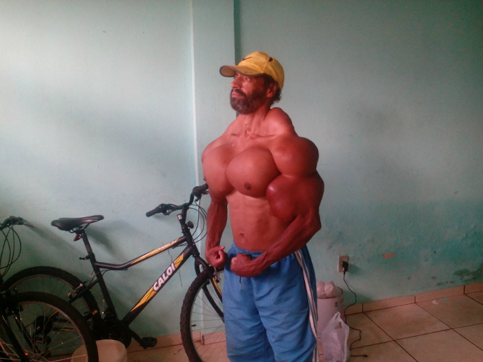 This Body-Builder Has Been Injecting Oil To Get 23-Inch Biceps And ...