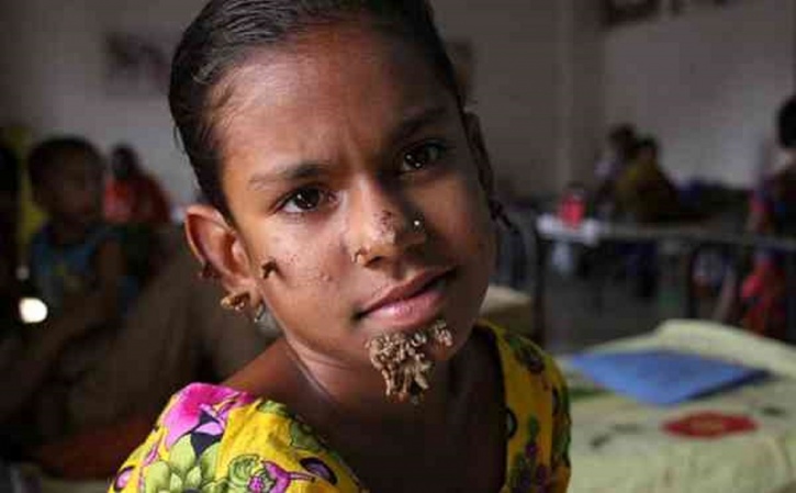 Meet 10 Yo Sahana Khatun The First Female To Be Diagnosed With Tree