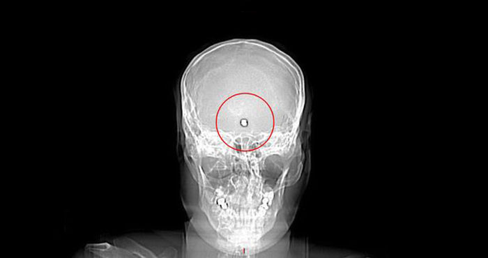 Miraculous! Man Survives Shot In The Head As Bullet Passes Through ...