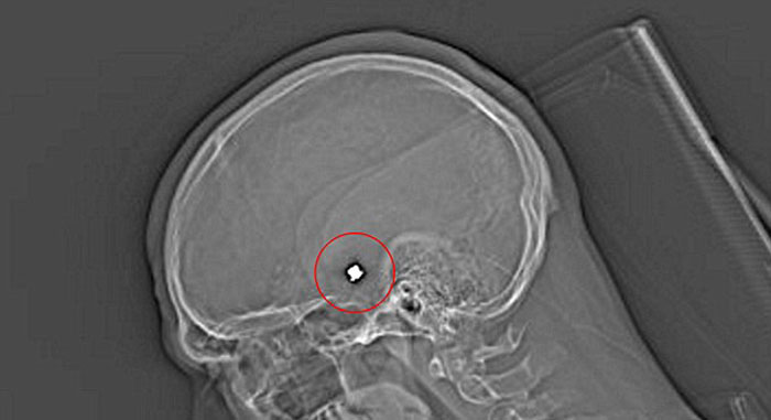 Miraculous Man Survives Shot In The Head As Bullet Passes Through