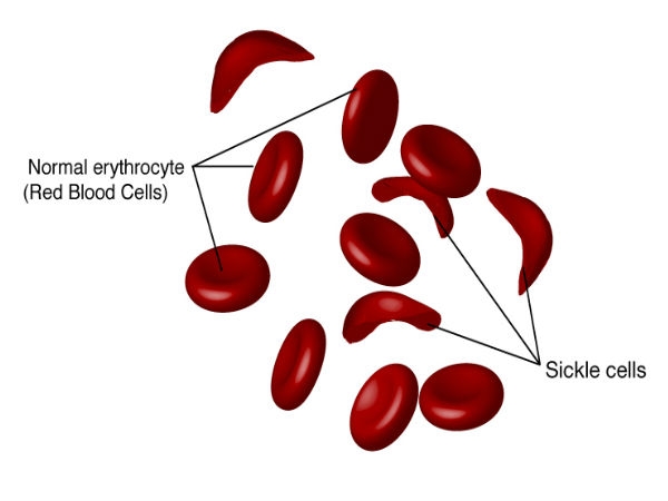 What is Sickle Cell Diseases | Healthy Living