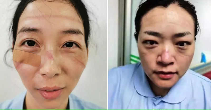 Doctors Braving Face Mask Scars, Working Long Hours To Treat ...