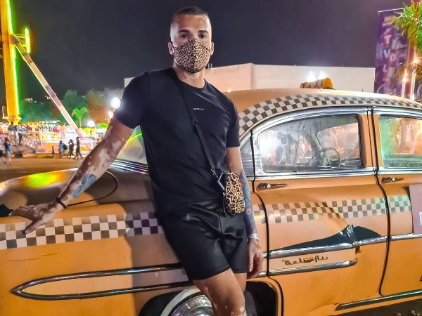 How One Model With Vitiligo Became A Source Of Inspiration For Millions