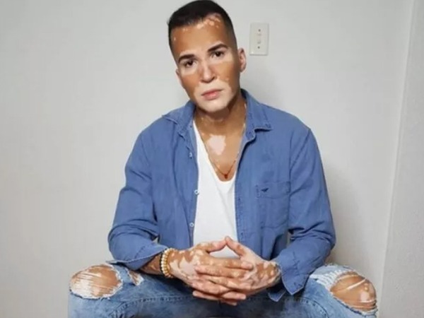 How One Model With Vitiligo Became A Source Of Inspiration For Millions
