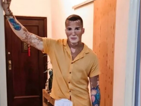 How One Model With Vitiligo Became A Source Of Inspiration For Millions