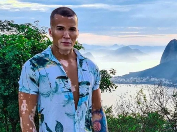 How One Model With Vitiligo Became A Source Of Inspiration For Millions