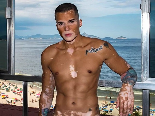 How One Model With Vitiligo Became A Source Of Inspiration For Millions