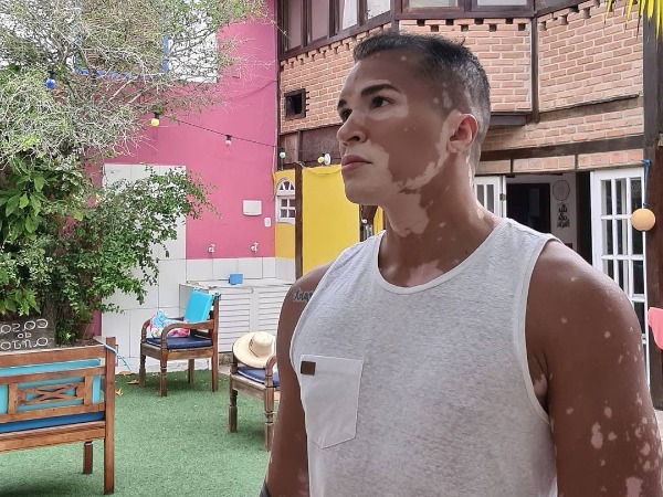How One Model With Vitiligo Became A Source Of Inspiration For Millions