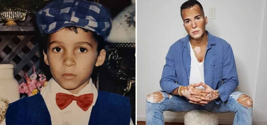 How One Model With Vitiligo Became A Source Of Inspiration For Millions